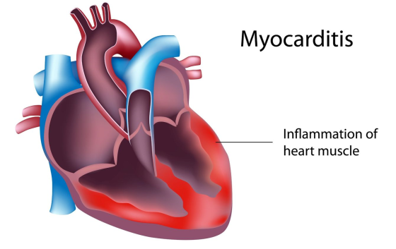 What Is Inflammation Of The Heart Called HomeworkLib what-is-inflammation-of-the-heart-called-homeworklib